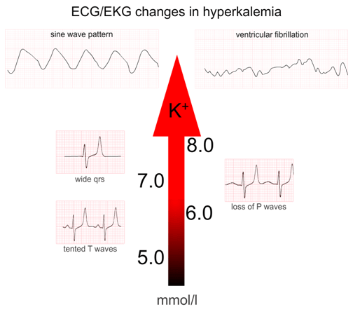Hipercalemia Ecg